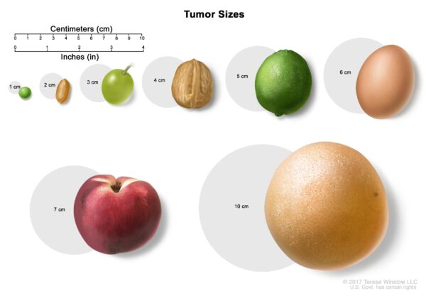 Staging Perihilar (Hilar or Klatskin Tumor) Cholangiocarcinoma